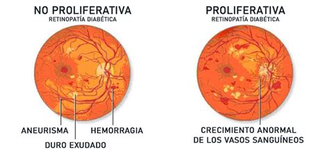 Retinopatia Diabetica Que Es Y Cuales Son Sus Tratamientos Cl Nica