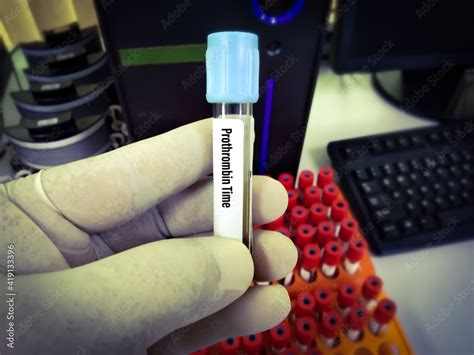 Foto De Blood Sample For Activated Partial Thromboplastin Time Aptt