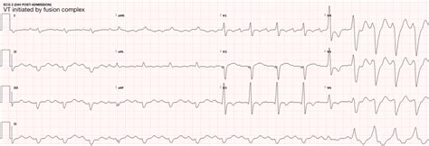 Differential Diagnosis Of Nonsustained Ventricular Tachycardia