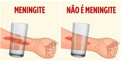 Sintomas De Meningite Que Todos Os Pais Precisam Saber Natureza E Sa De