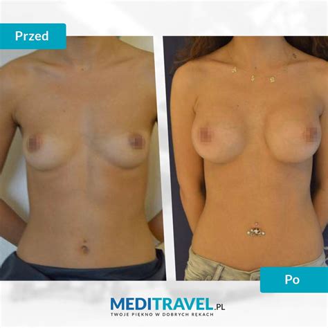 Best Breast Surgery Offers Meditravel