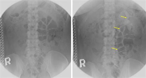 Unilateral Renal Agenesis Radiology Cases
