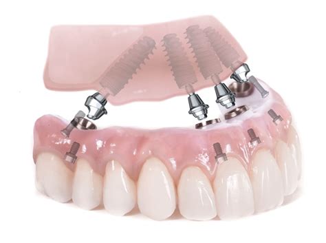 Revolutionize Your Smile All On 4 Or All On 6 Dental Implants