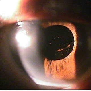 External Appearance Of The Eye With Severe Chemosis And Hyperemia A