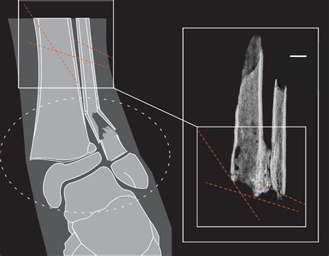A Salterharris Type Ii Fracture Of Left Tibia And Fibula Similar To