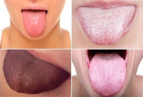 Has Observado El Color De Tu Lengua Has Visto Manchas Blancas O