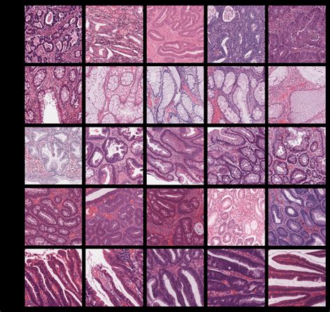 hande samples of colorectal polyps the figure shows five different download scientific diagram