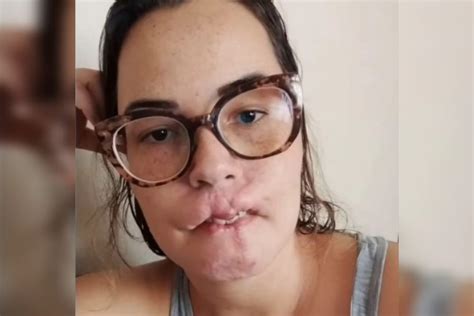 Mulher que perdeu lábios após preenchimento desabafa Fui enganada