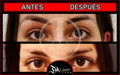 Cómo queda la piel antes y después de borrar un tatuaje