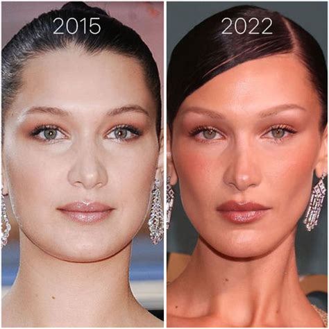 Bella Hadid Avant Apres Bichectomie Dr Skander HENDAOUI Chirurgien