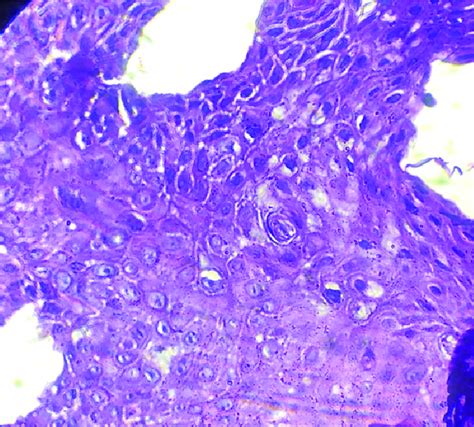 Well Differentiated Squamous Cells Carcinoma Of Esophagus H E X40