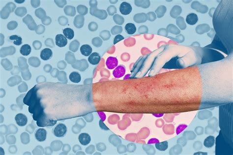 Éruptions cutanées leucémiques pourquoi ces lésions cutanées se