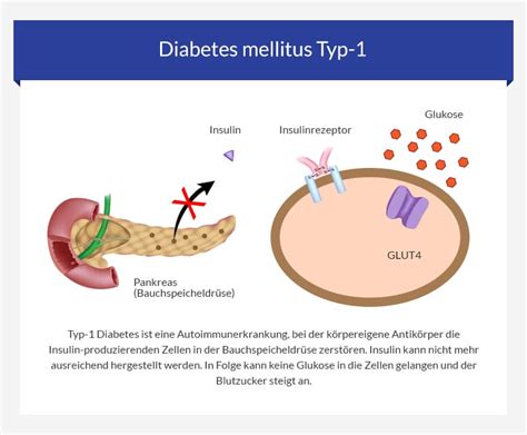 Diabetes Mellitus Ödem Ursachen Symptome Behandlung Und Vorbeugung