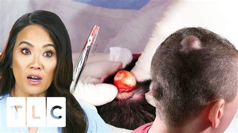 Dr Lee Gets Sprayed By Explosive Cyst On Man S Head Dr Pimple