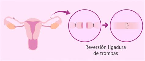 Reversión de la ligadura de trompas