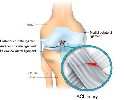 Torn Knee Ligaments Ligament Knee Tear Acl Acl Injury Mcl Of Knee