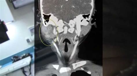 Parotid Gland Swelling Or Parotitis YouTube