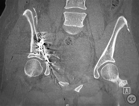 Associated Both Column Acetabular Fracture Milton Lee Chip Routt