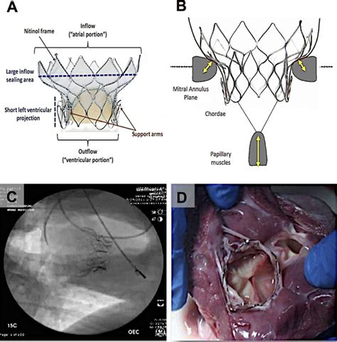 Percutaneous Mitral Valve Replacement