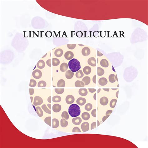 Linfoma Folicular Atlas Em Hematologia