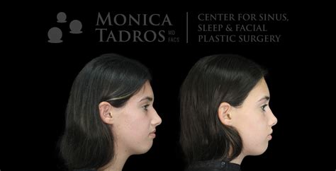 Teenage Rhinoplasty Dr Monica Tadros Sinus Sleep Facial