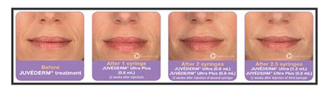 Juvederm Lips Before And After Syringe Lipstutorial Org