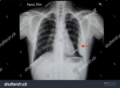 Photo De Stock Chest Xray Film Patient Loculated Pleural 797148022