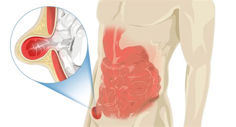 Hernia Inguinal Niddk