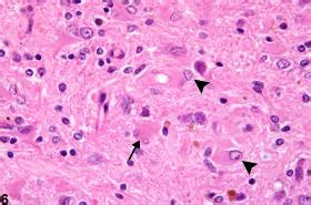 Brain Microgliosis Nonneoplastic Lesion Atlas