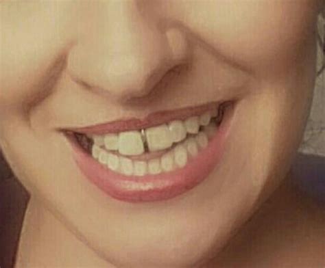 Gold Insert In Teeth Gap Teeth Gold Grillz Grills Tooth Ass Insert