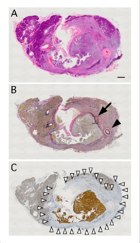 Overview Of The Pancreatic Lesion A Hematoxylin And Eosin HE