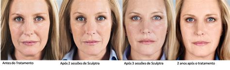 Sculptra Bioestimulador de Colágeno Estética Facial e Corporal
