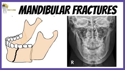 MANDIBULAR FRACTURES Clinical Features Radiographic Diagnosis Oral