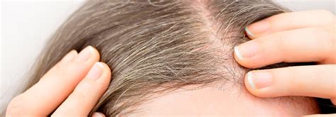 Cómo afecta la alopecia femenina Consejos y soluciones Clínica La