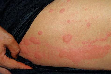 Urticaria por frío qué es y cómo curarla Conoce todos sus síntomas y