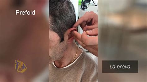 La Correzione Mini Invasiva Delle Orecchie A Sventola Con Earfold
