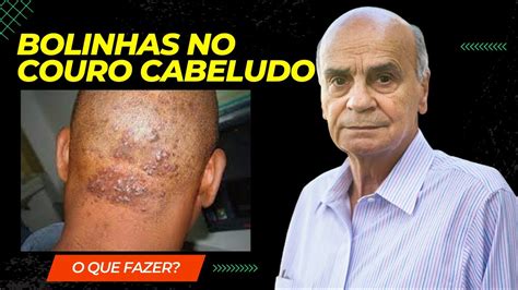 Foliculite No Couro Cabeludo Saiba Como Tratar Youtube