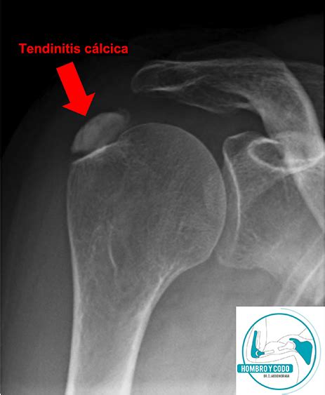 Tendinitis C Lcica Cirujano Hombro Codo