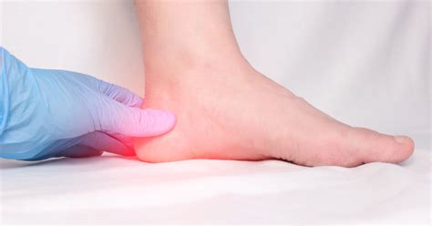 Espolón calcáneo causas síntomas y tratamiento Espai Vital Benissa