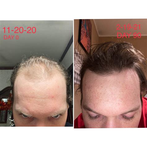 Ambiguo Trimestre Esc Ptico Minoxidil Hairline Before After Grifo