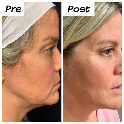 Vivace RF Micro Needling