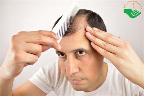 Tóc rụng nhiều ở nam Nguyên nhân và cách chữa trị hiệu quả nhất