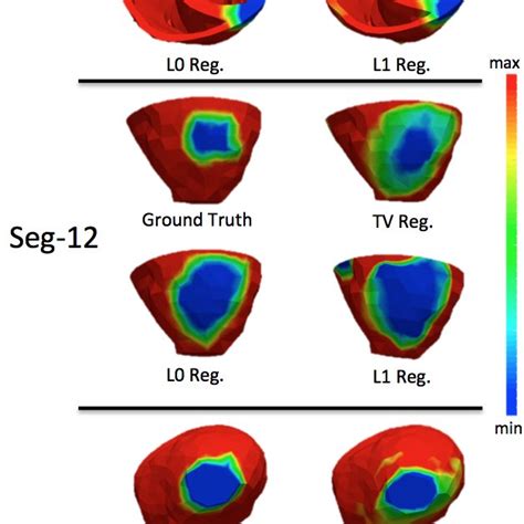 reconstruction of transmural infarcts using total variation l0 norm download scientific