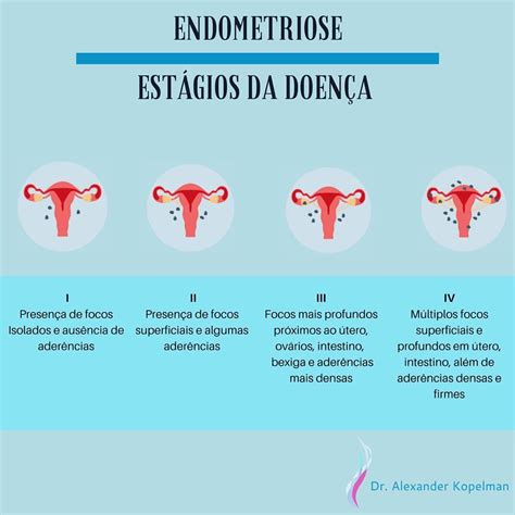 Endometriose O que é sintomas e seus estágios Raquel Luiza