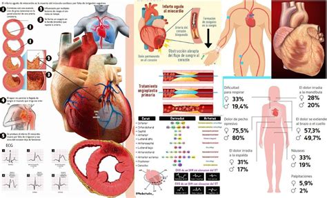 Infografía Infarto Agudo al Miocardio Luis Fabrizio Chapital Velasco