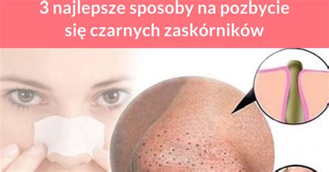 3 najlepsze sposoby na pozbycie się czarnych zaskórników