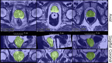 table 1 from medical image segmentation using 3d convolutional neural vrogue