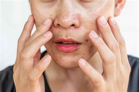 Quels sont les traitements beauté pour la peau grasse