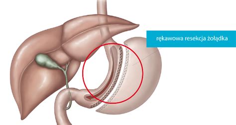 RĘKAWOWA RESEKCJA ŻOŁĄDKA Sleeve Gastrectomy ECZ Otwock