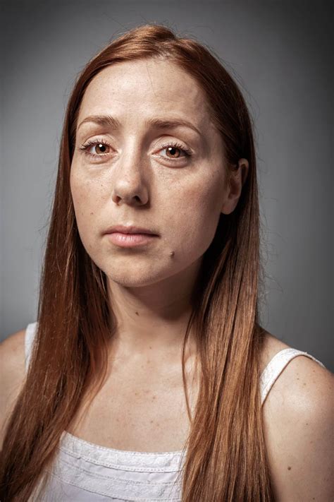 The Ozempic Face Effect What You Need To Know Bmi Doctors